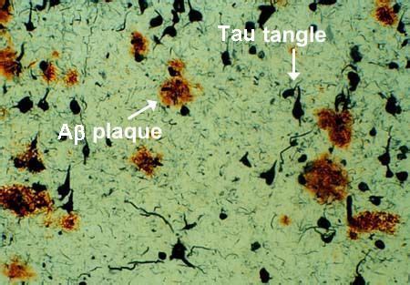 Amyloid Plaques And Tau Tangles By Bredesen Dr Blake Porter