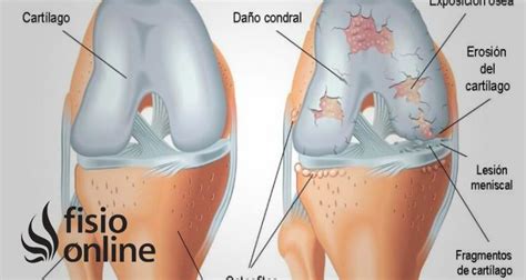 Osteofitos Qué Es Qué Estructuras Afecta Síntomas Signos Clínicos Causas Y Tratamiento