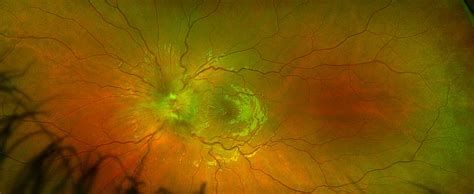 Critical Eye Conditions Found Using Optomap Walker And Campbell