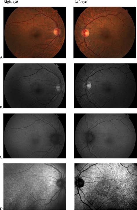 Figure 1 From A Case Of Tacrolimus Maculopathy Semantic Scholar