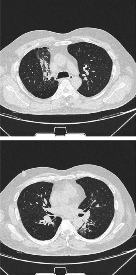 A Chest Ct Scan Patchy Ground Glass Consolidation Associated With