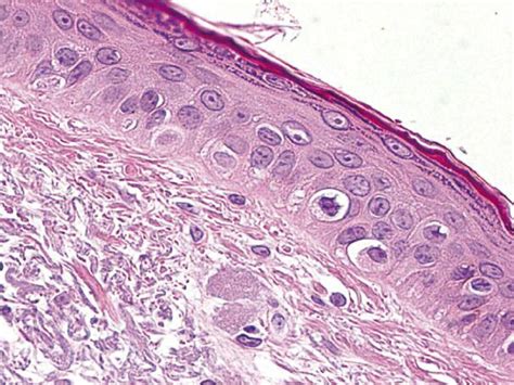 “senile” Keratosis Atrophic Type Of Elastosis In The Dermis Staining