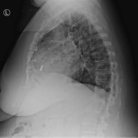 Pdf Implantation Of Leadless Pacemaker For The Development Of New Left Bundle Branch Block And