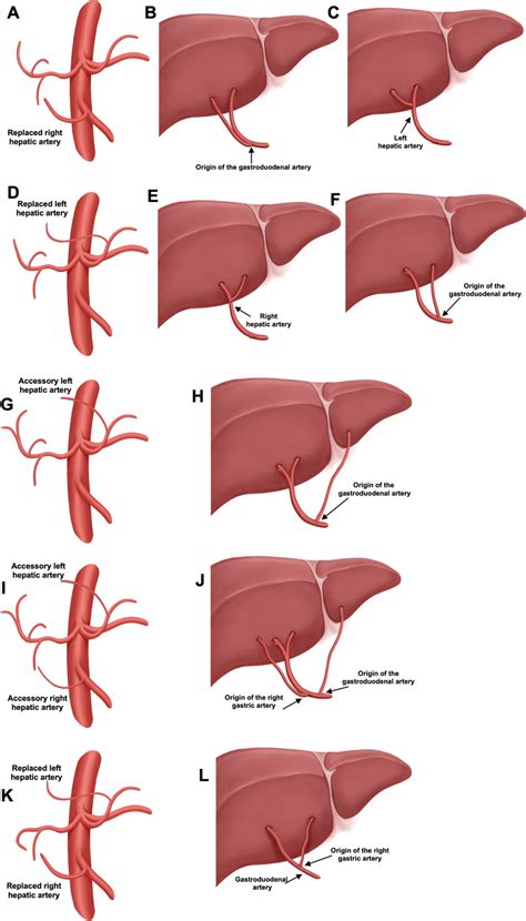 Hepatic Arterial Anatomy