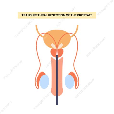 Transurethral Resection Of Prostate Conceptual Illustration Stock Image F0433422 Science