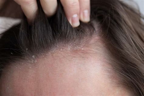 Scalp Psoriasis Vs Dandruff How Do I Tell The Difference