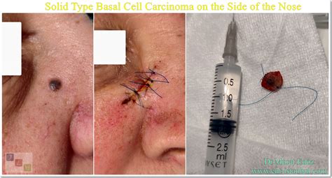 We Performed An Excision Of Solid Type Basal Cell Carcinoma From The