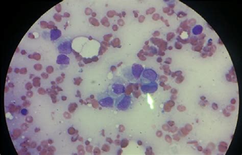 Myelophthisic Anemia In A Patient With Lobular Breast Carcinoma
