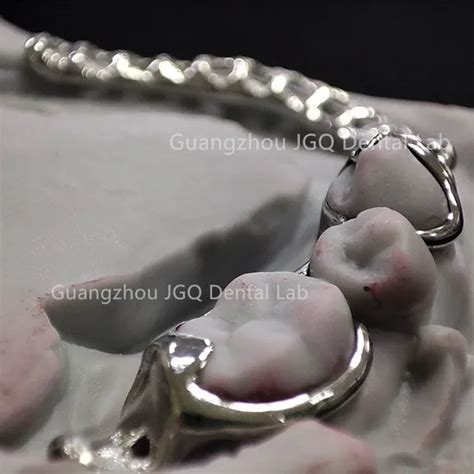 Durable Maxillary Mandibular Metal Framework With False Teeth Acrylic