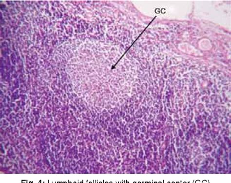 Lymphoepithelial Cyst Of Tonsil Semantic Scholar