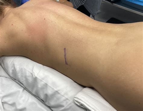 Technical Strategies Longitiudinal Ld Muscle Resection In Rib Removal Surgery For Waist