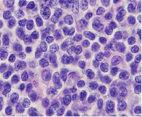Cytology Image Shows Small Cells With Hyperchromatic And Cleaved Download Scientific Diagram