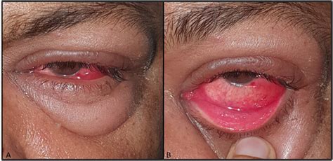 Viral Conjunctivitis Follicles Conjunctivitis Anesthesia Key