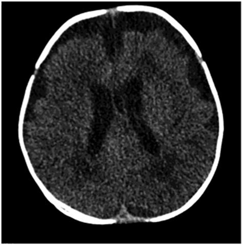 No Definite Intracranial Abnormality And No Definite Abnormal Download Scientific Diagram