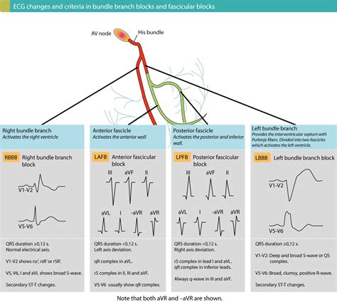 Intraventricular Conduction Delay Bundle Branch Blocks And Fascicular Blocks The Cardiovascular