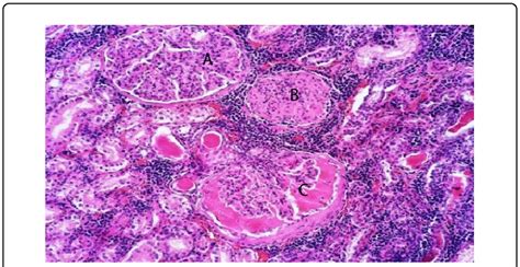 Three Glomeruli Showing Different Lesions A Periglomerular Fibrosis