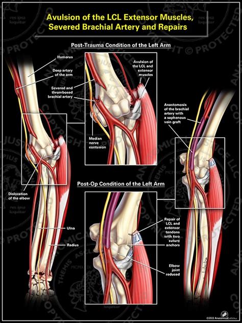 Avulsion Of The Lcl Extensor Muscles And Severed Brachial Artery