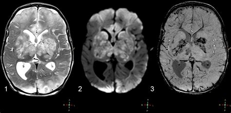 A Case Report Of Acute Necrotizing Encephalitis Yleav