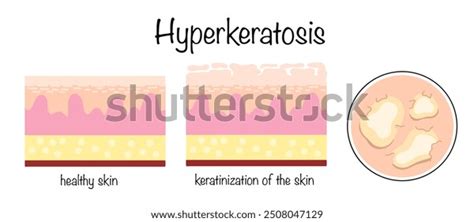 Hyperkeratinization Acne