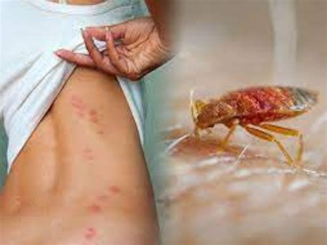 Alerta En Varias Ciudades Del Mundo Por La Plaga De Chinches Que