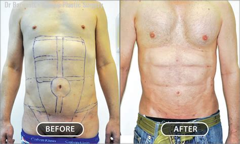 Abdominal Etching Surgery