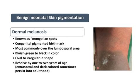 Mongolian Spots Spot Diagnosis 29 Pediatrics Youtube