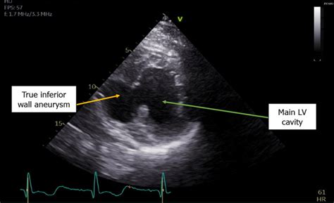 Massive Inferior Wall Aneurysm Presenting With Ventricular Tachycardia
