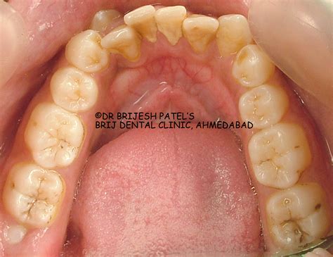 Braces Before And After Pictures Orthodontic Before And After Results