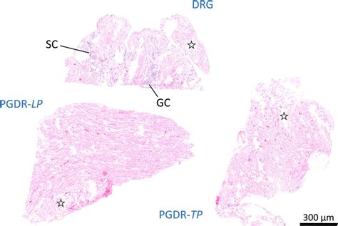 Imaging And Histopathologic Features Of Reversible Nerve Root And