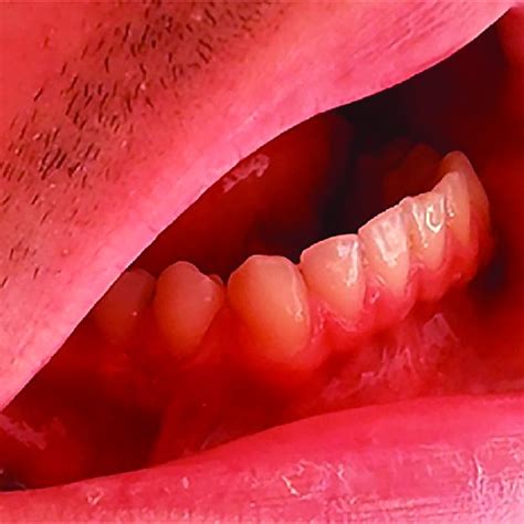 Pdf Focal Oral Pigmentation On The Gingiva Of Mandible A Case Report