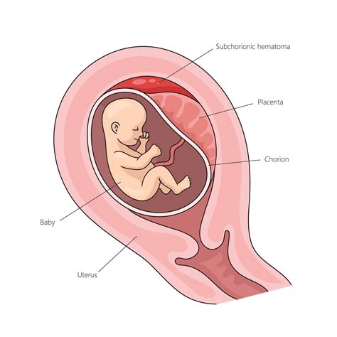 What Causes Placental Abruption Placental Abruption Causes Placental Abruption Risk Factors