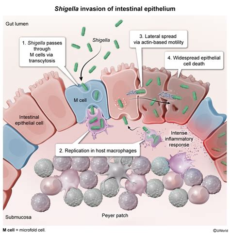 Shigella Infection Shigellosis Gastroenterology Uworld Medical