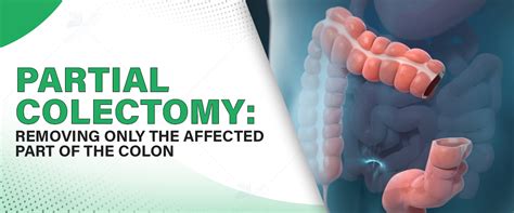 Partial Colectomy Removing Only The Affected Part Of The Colon