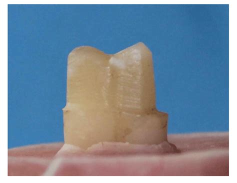 Modified Preparation With Buccal Shoulder And Lingual Chamfer