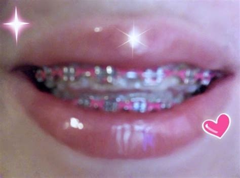 ⋆｡˚ Braces Colors Cute Braces Cute Braces Colors