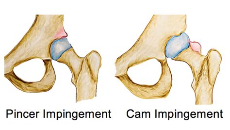 Femoroacetabular Impingement Fai