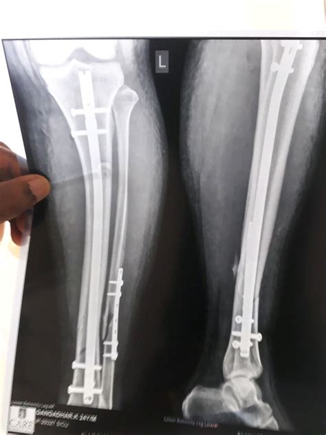 Gangadhar Kunchey On Linkedin This Is My Left Leg X Ray Which Has Been Taken In The Year 2017
