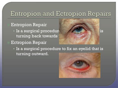 Ppt Eyelid Tear Duct And Orbital Surgery Powerpoint Presentation