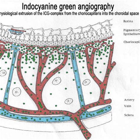 Difference Between Fluorescein Fa And Indocyanine Green Angiography