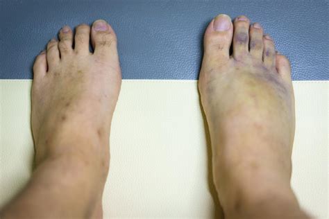 Purple Feet Causes And Treatment