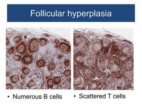 Non Neoplastic Lesions Of Lymph Node Pptx