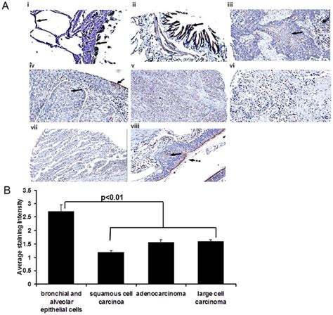 Bit1 Is Downregulated In Nsclc Tissues A Lung Tumor Tissue Array