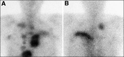 Diagnosis And Corresponding Gallium Scan