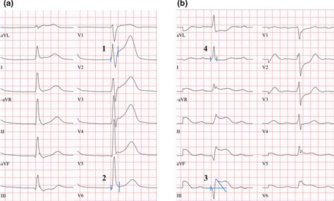 Electrocardiography Examples From A Patient With A Lad Occlusion A