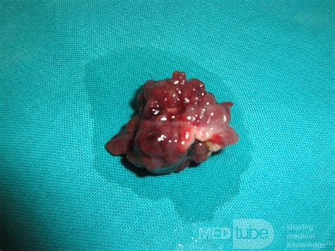 Giant Multilobulated Gastric Polyp 18 Of 20 • Image •