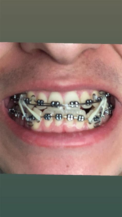 Amazing Non Surgical Underbite Correction Braces 1 Year R Braces