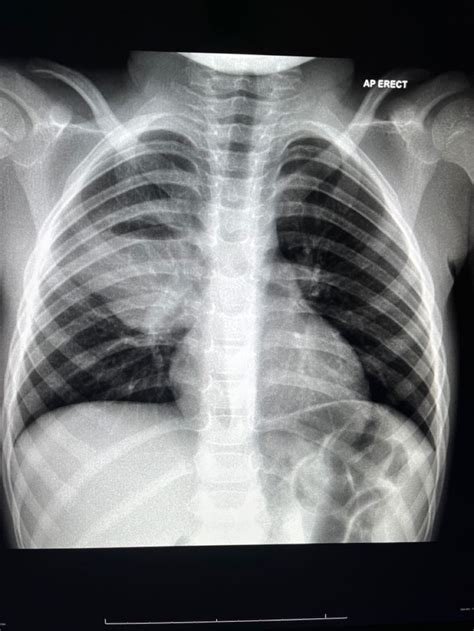 Air Fluid Levels On Chest X Ray At Abby Choi Blog