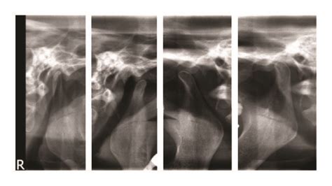 Tmj Tomographic Views Which Revealed An Excessive Anterior Movement Of