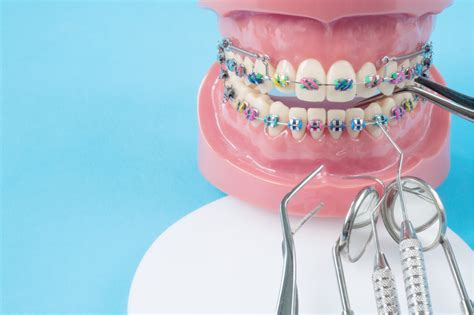 Teeth Brace