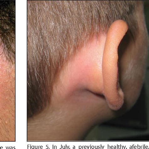 Figure 5 From Mastoiditis Mimicry Retro Auricular Cellulitis Related To Otitis Externa